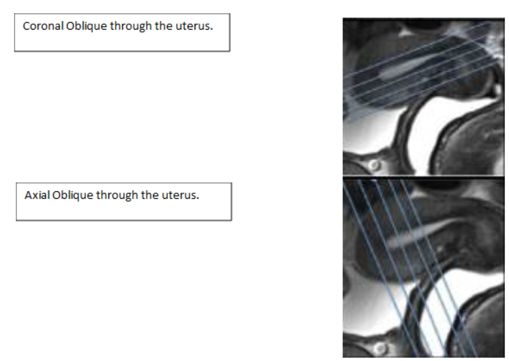 MR CONGENITAL FEMALE PELVIS WO BODY Protocol | OHSU